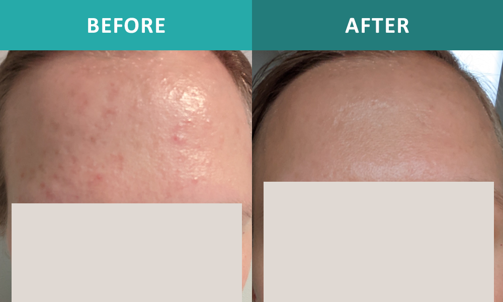 Natural Treatments for Acne | Acne Dermatologist Los Angeles