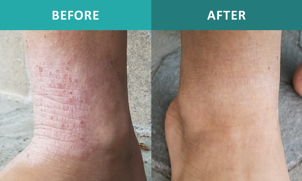 Natural Treatments for Eczema | Eczema Dermatologist Los Angeles