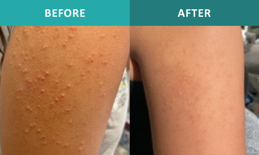 Natural Treatment for Rashes | Dermatologist Los Angeles