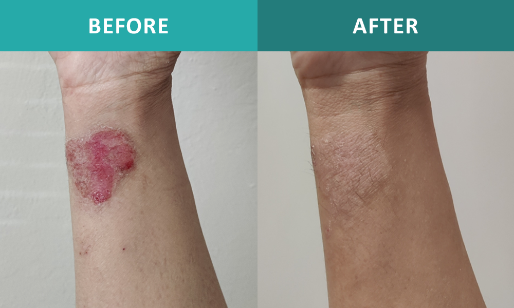 Natural Treatments for Eczema | Eczema Dermatologist Los Angeles