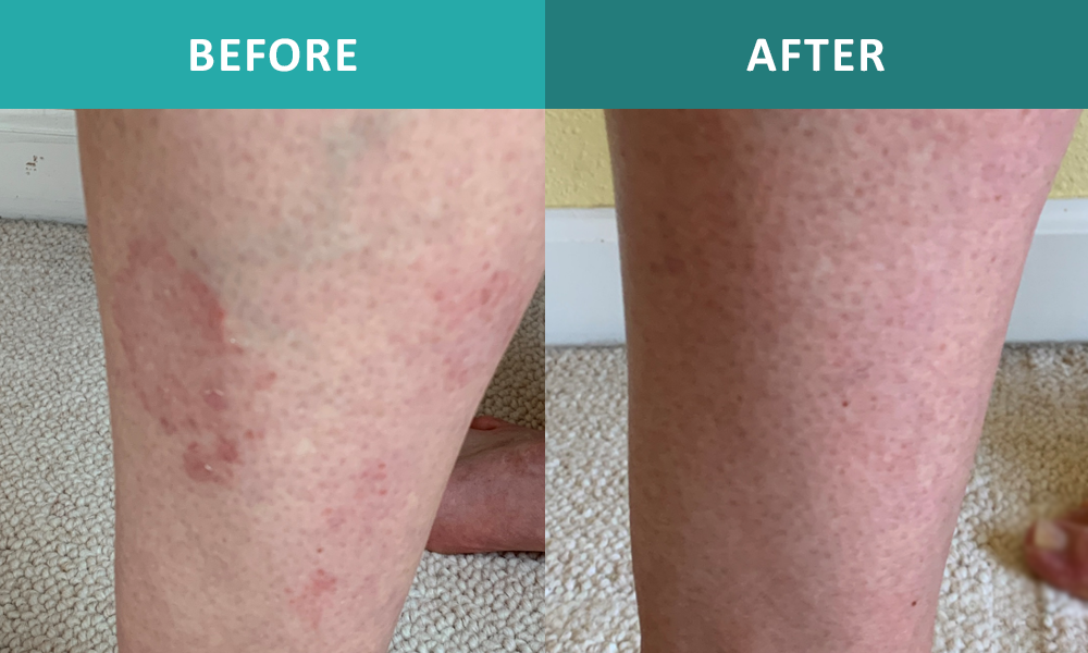 Natural Treatments for Psoriasis | Dermatologist Los Angeles