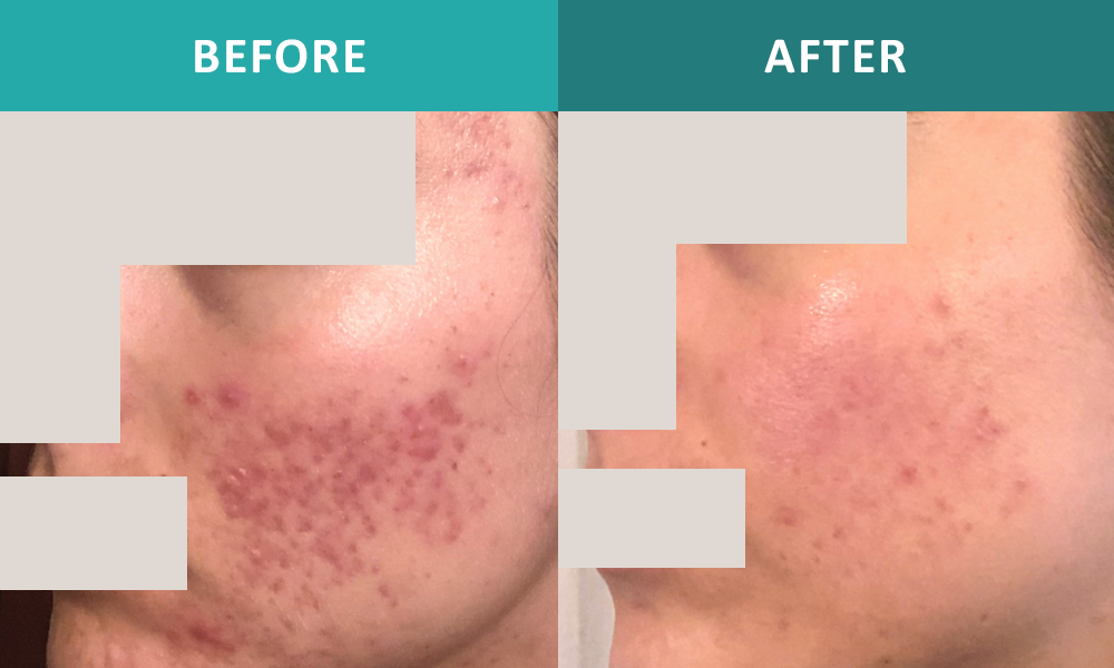 Natural Treatments for Acne | Acne Dermatologist Los Angeles