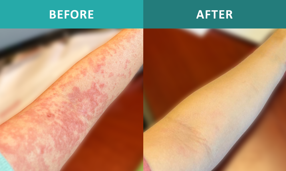 Natural Treatments for Eczema | Eczema Dermatologist Los Angeles