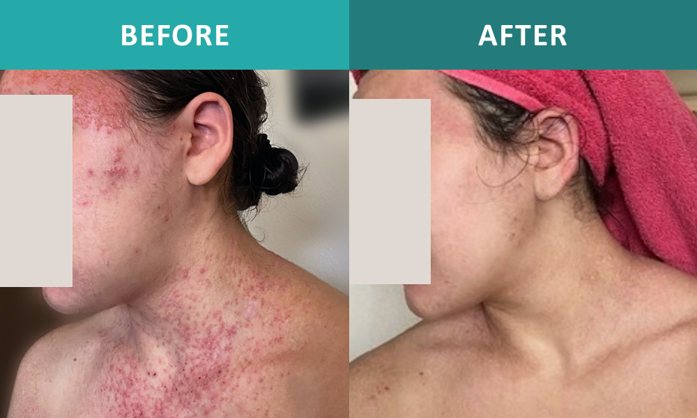 Natural Treatment for Rashes | Dermatologist Los Angeles