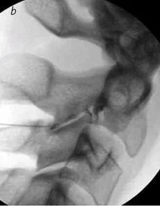 Facet Injections and RFA Phoenix | Dr. Jerry Sobel