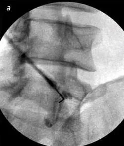 Facet Injections and RFA Phoenix | Dr. Jerry Sobel