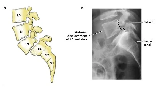 Spondylolisthesis L5 S1