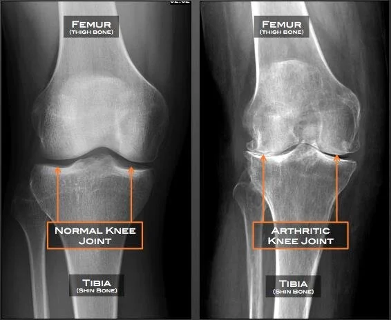 Non-Surgical Knee Pain Treatment Phoenix, AZ | Dr. Jerry Sobel