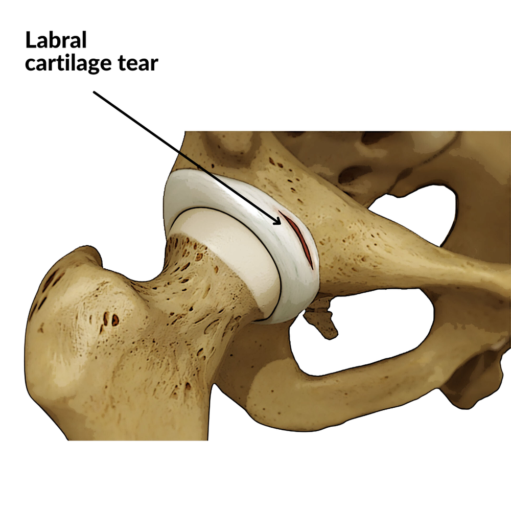 Hip Labral Tear Treatment Phoenix | Dr. Jerry Sobel