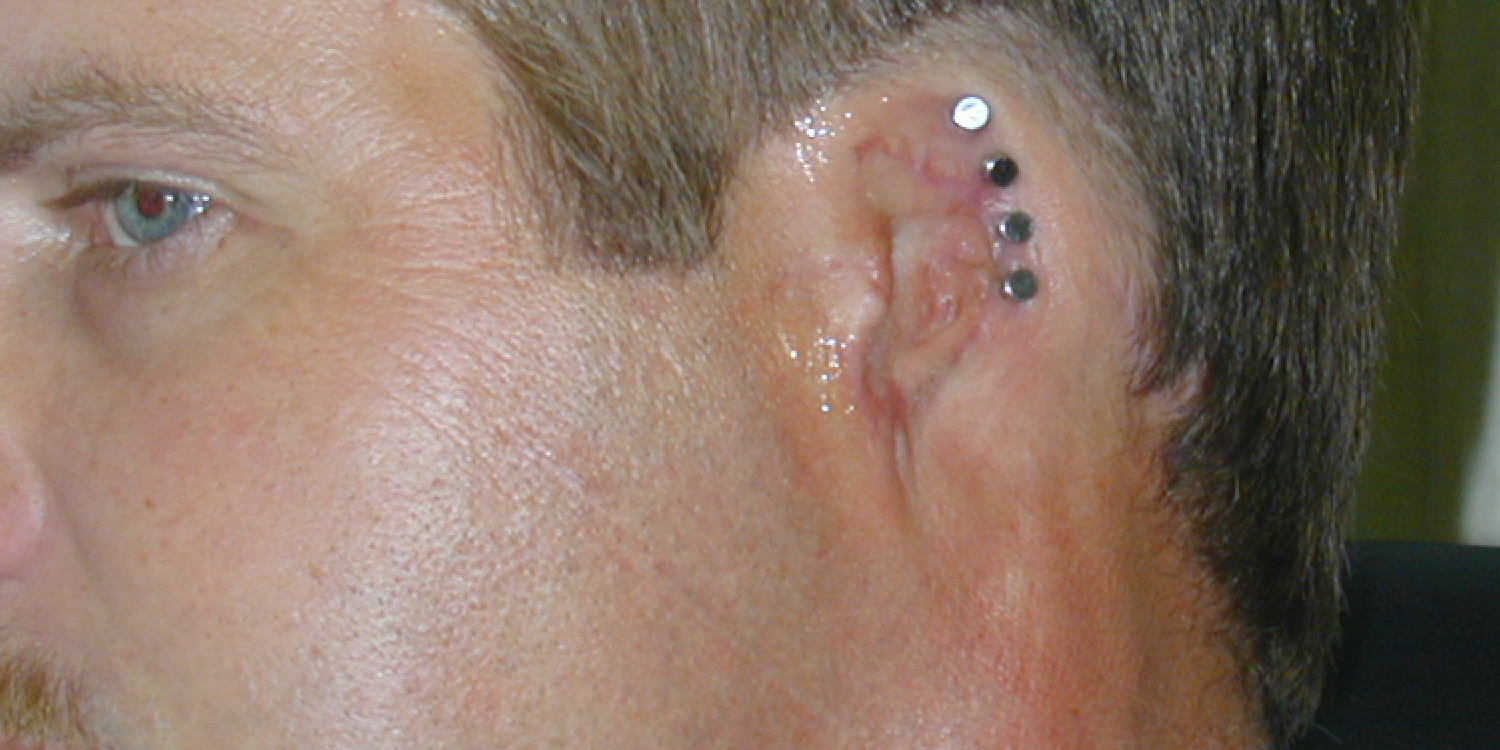 FacialProsthetics — Scott Fiscus, B.C.O.