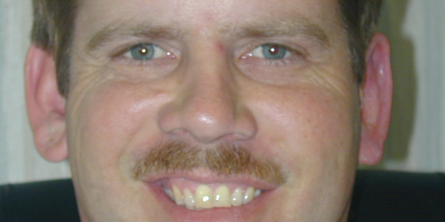 FacialProsthetics — Scott Fiscus, B.C.O.