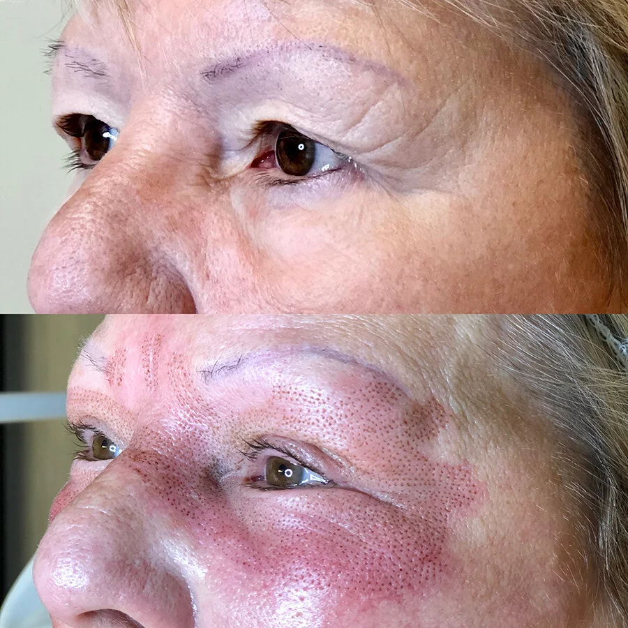 Fibroblast Plasma Skin Tightening — Izar Wellness Institute
