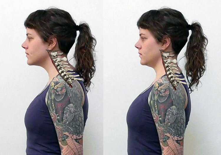 Which neck muscles are affected by a head forward position? — Dynamic ...