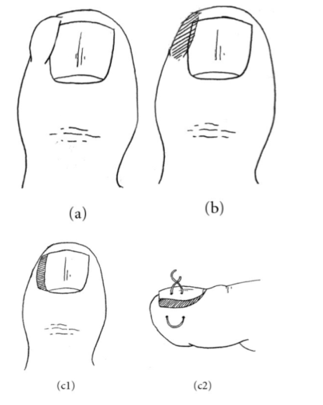 Ingrown Toenail — Cosmetic Medical Clinic