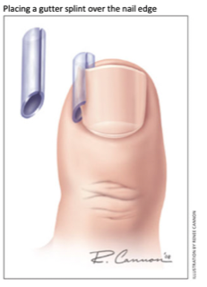 Ingrown Toenail — Cosmetic Medical Clinic