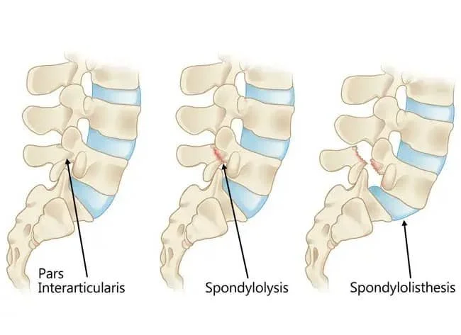 Managing Lumbar Spondylosis in Athletes: Sports Physical Therapy Near ...