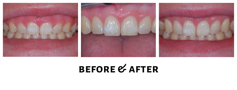 Dental Crown Lengthening In Maine — COREY+THEN