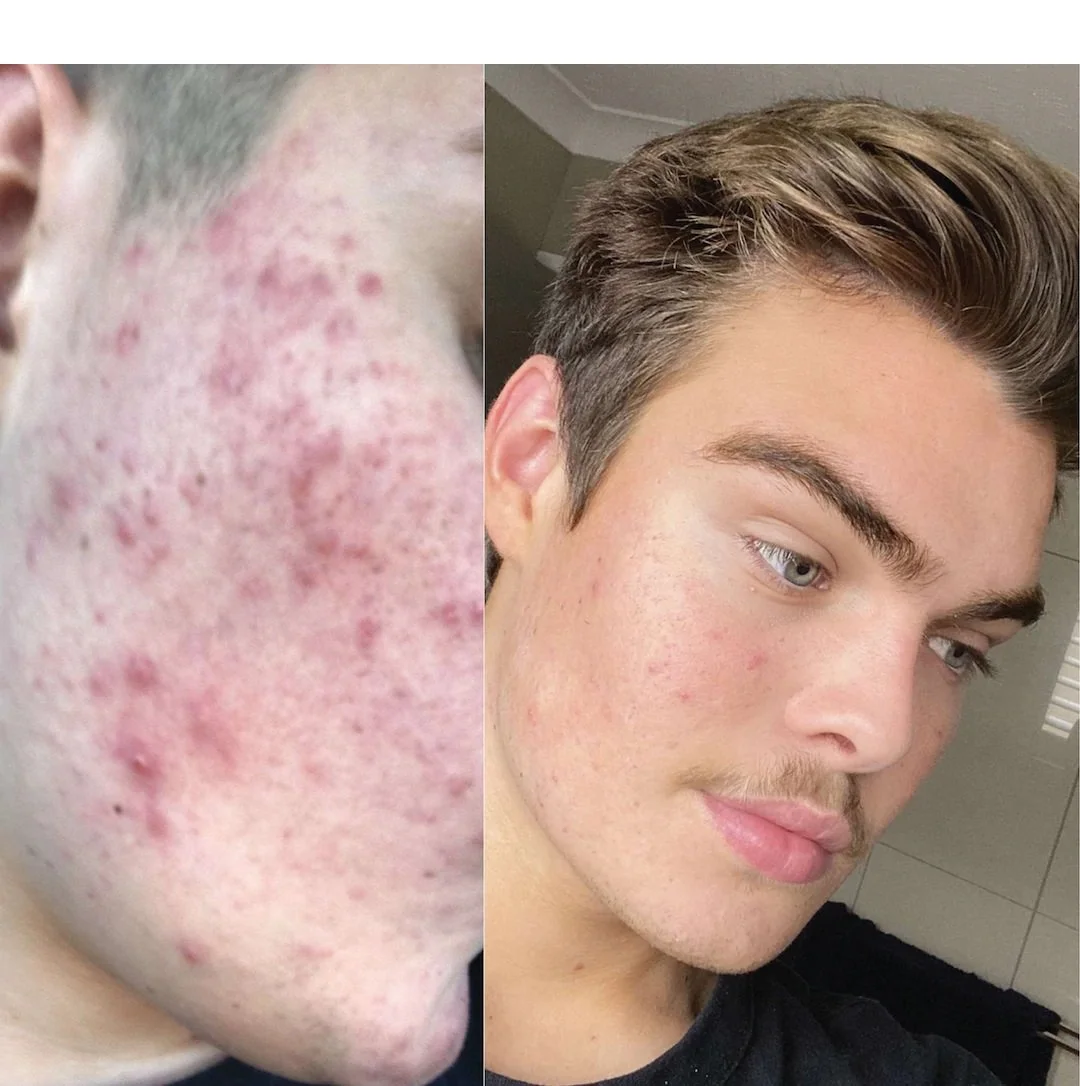 Clear Skin System — Chelsea's Beauty Retreat