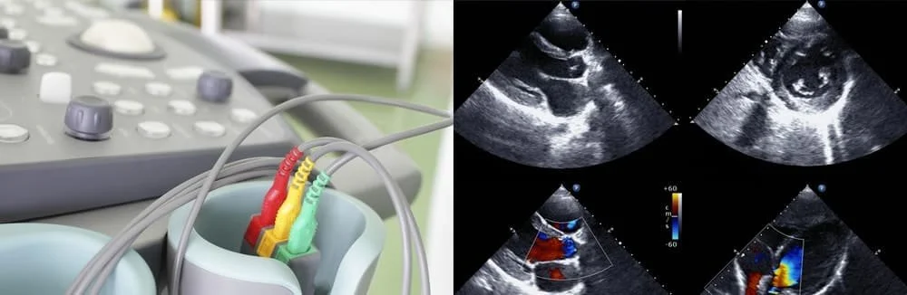 Echocardiography | Book Your Scan Today — Rezolut