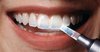 Tooth Wear : Acid Erosion — Homegirl Hygienist