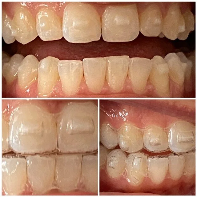 `My Invisalign Diary Weeks 1 - 21 — Homegirl Hygienist