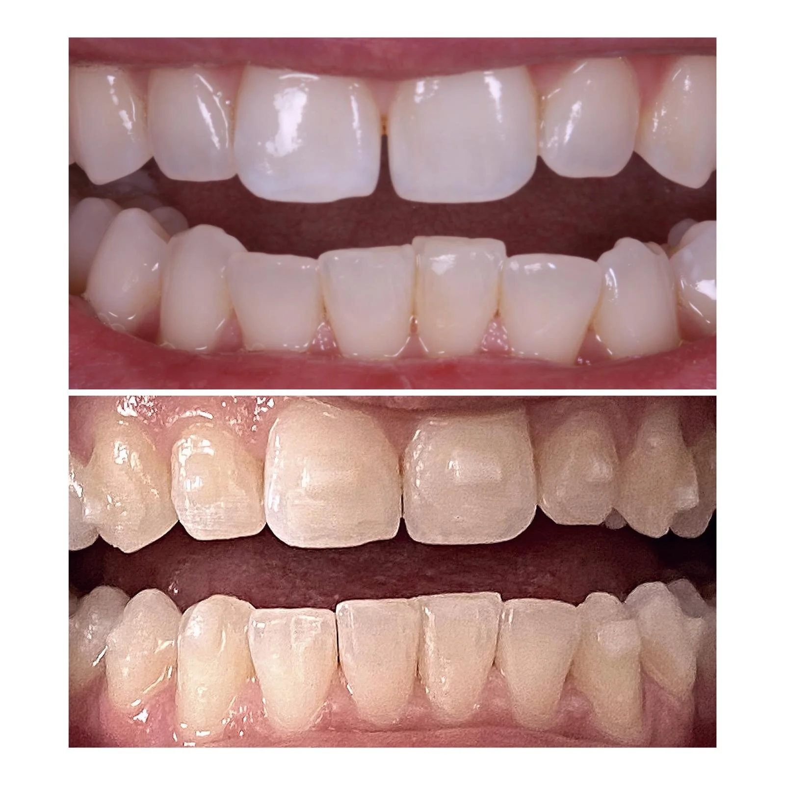 `My Invisalign Diary Weeks 1 - 21 — Homegirl Hygienist