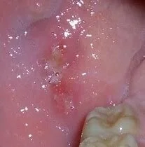 Top 5 Tips for Mouth Ulcers — Homegirl Hygienist