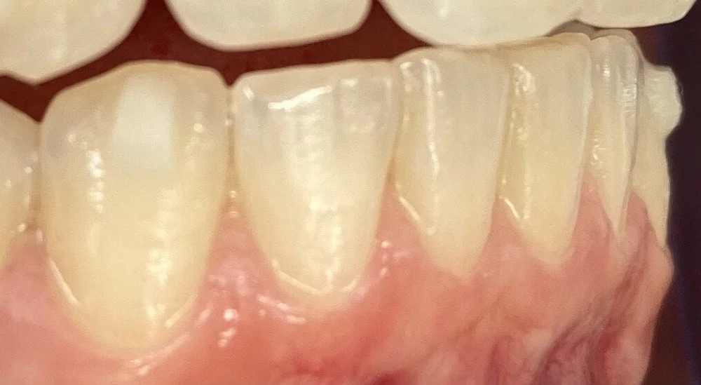 `My Invisalign Diary Weeks 1 - 21 — Homegirl Hygienist