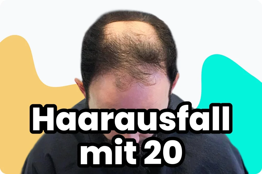 Haarausfall mit 20 – Entdecke die Freiheit mit wenighair