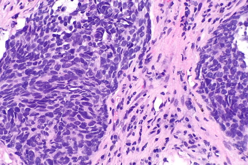 EGFR stands for epidermal growth factor receptor. | EGFR Positive UK