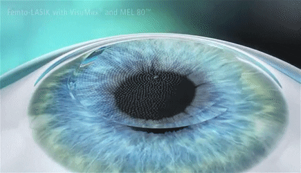 LASIK — Cataract and Eye Consultants of Michigan