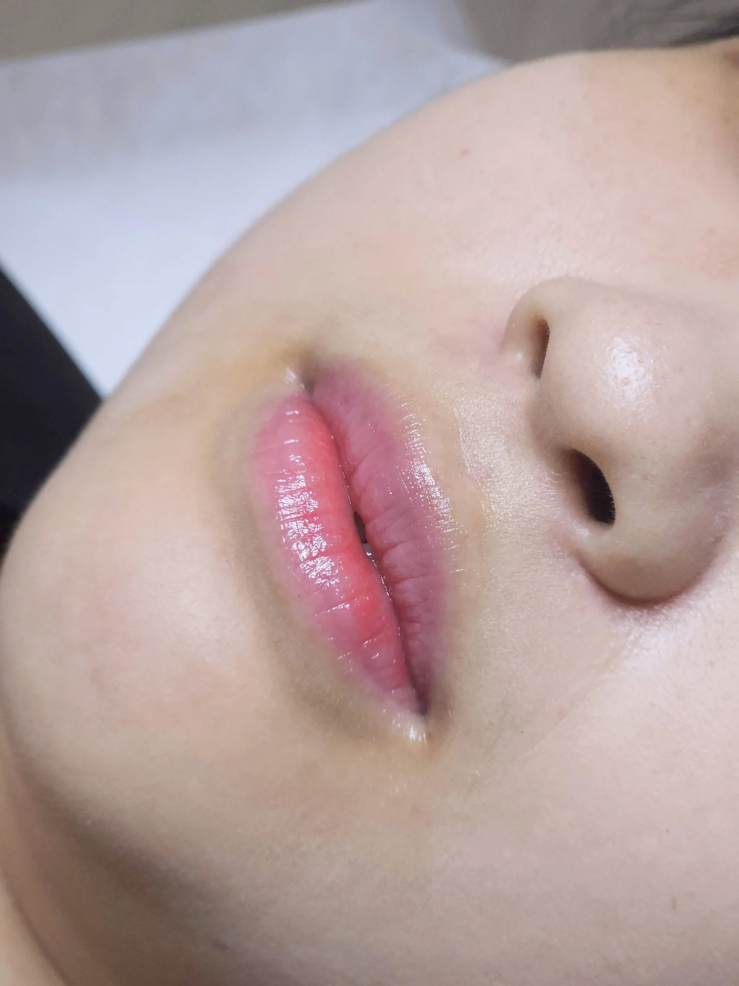 Lip Colour Removal in Singapore – Safe, Non-Invasive Treatment to ...