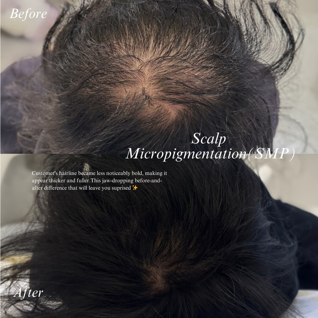 Top 5 Things You Need to Know About Scalp Micropigmentation — Singapore ...