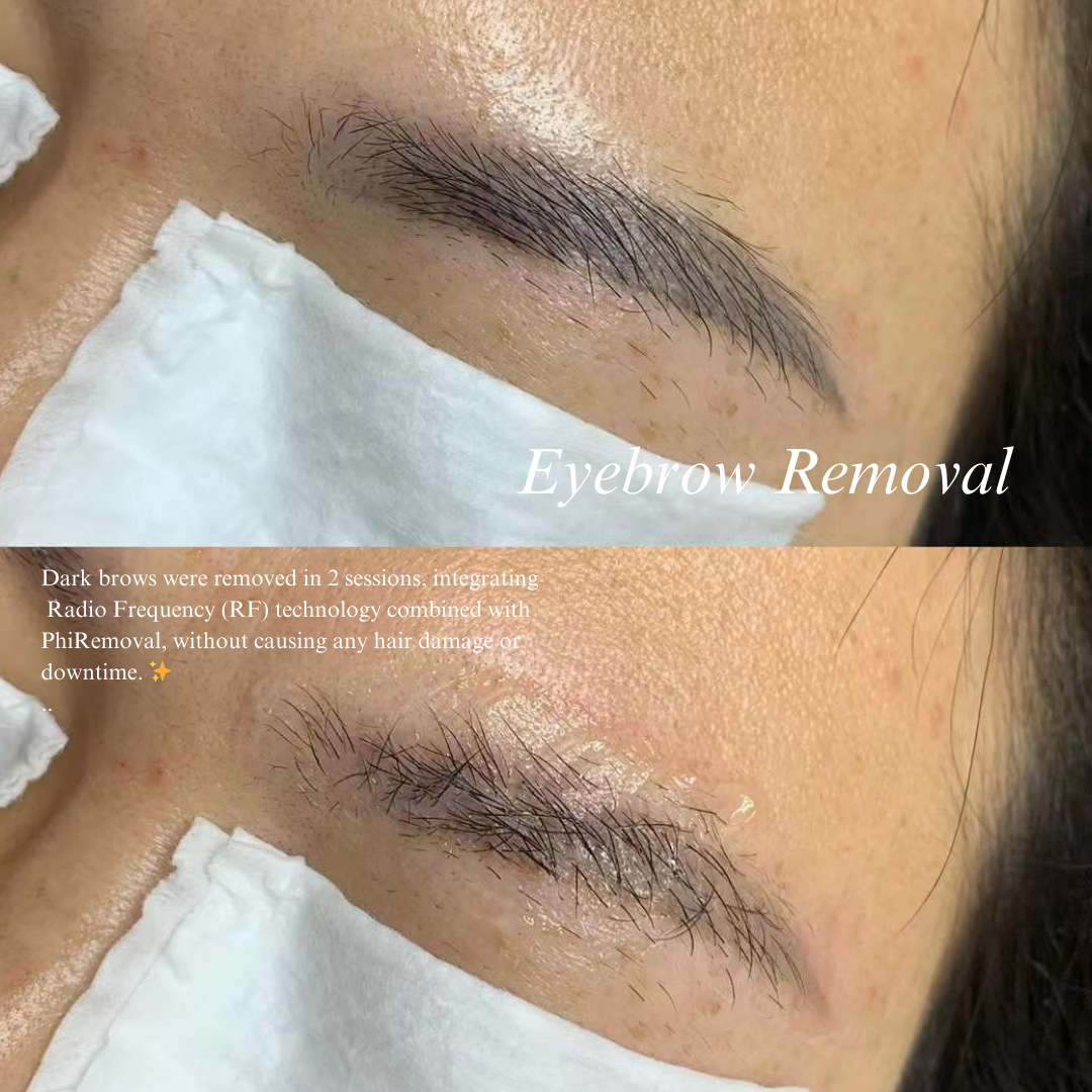 Correcting Botched Brows: Tiffany’s RF Revival Technique That Restores ...