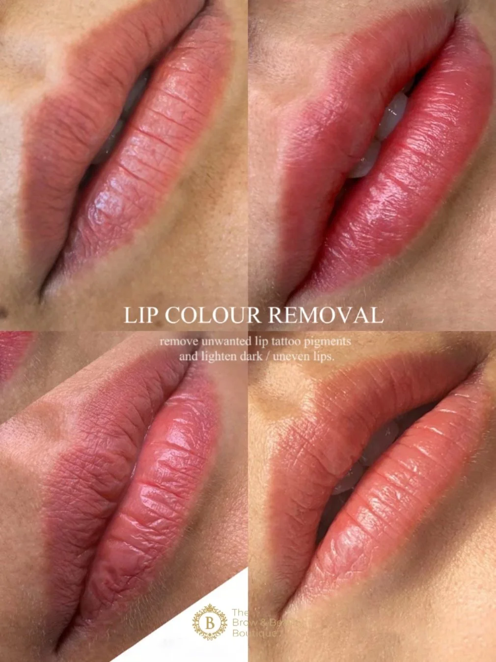 What Causes Two-Toned Lips (And How Can I Fix It?) — Singapore best ...