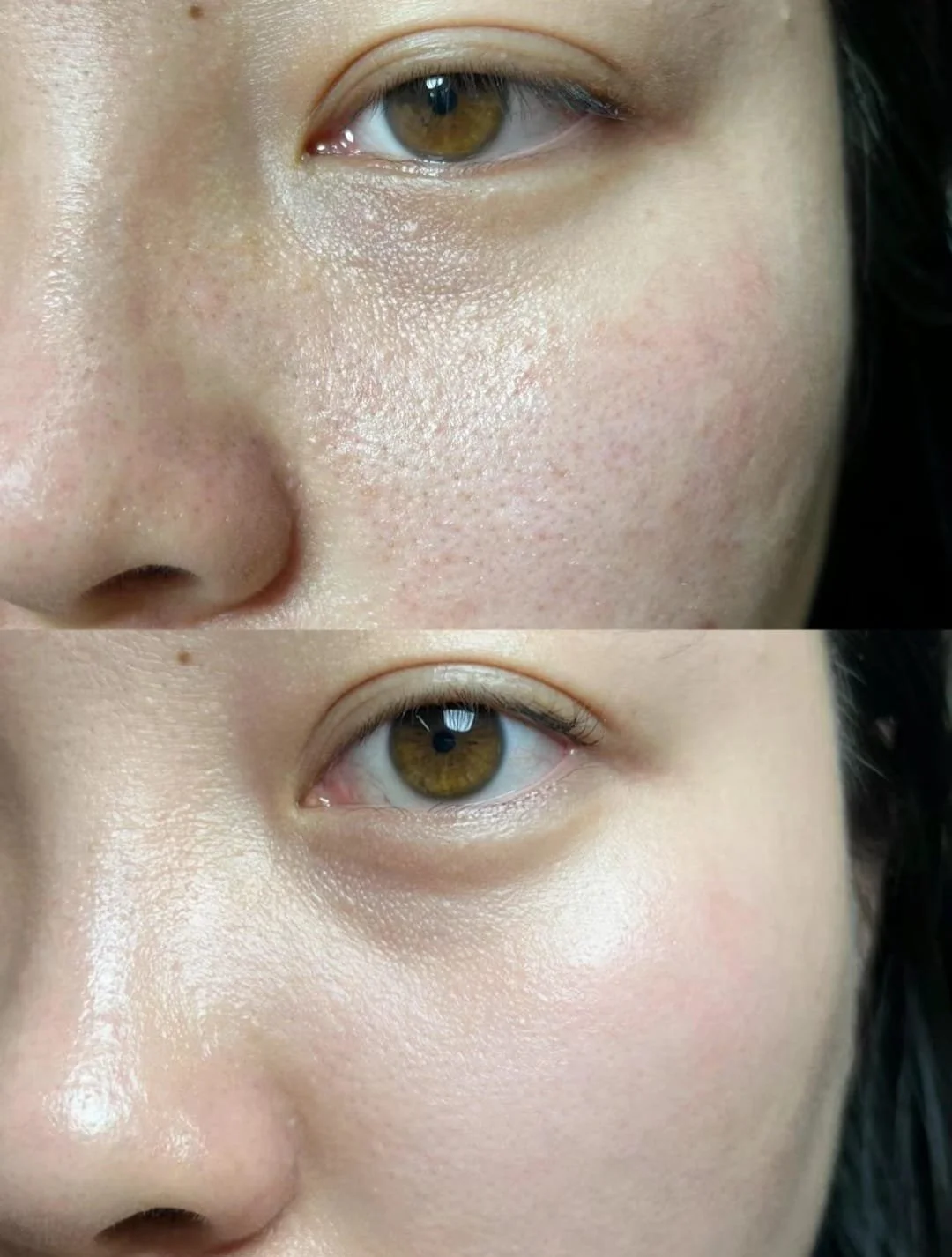 The Link Between Milia Seeds and Skin Management: Treating Bumps and ...