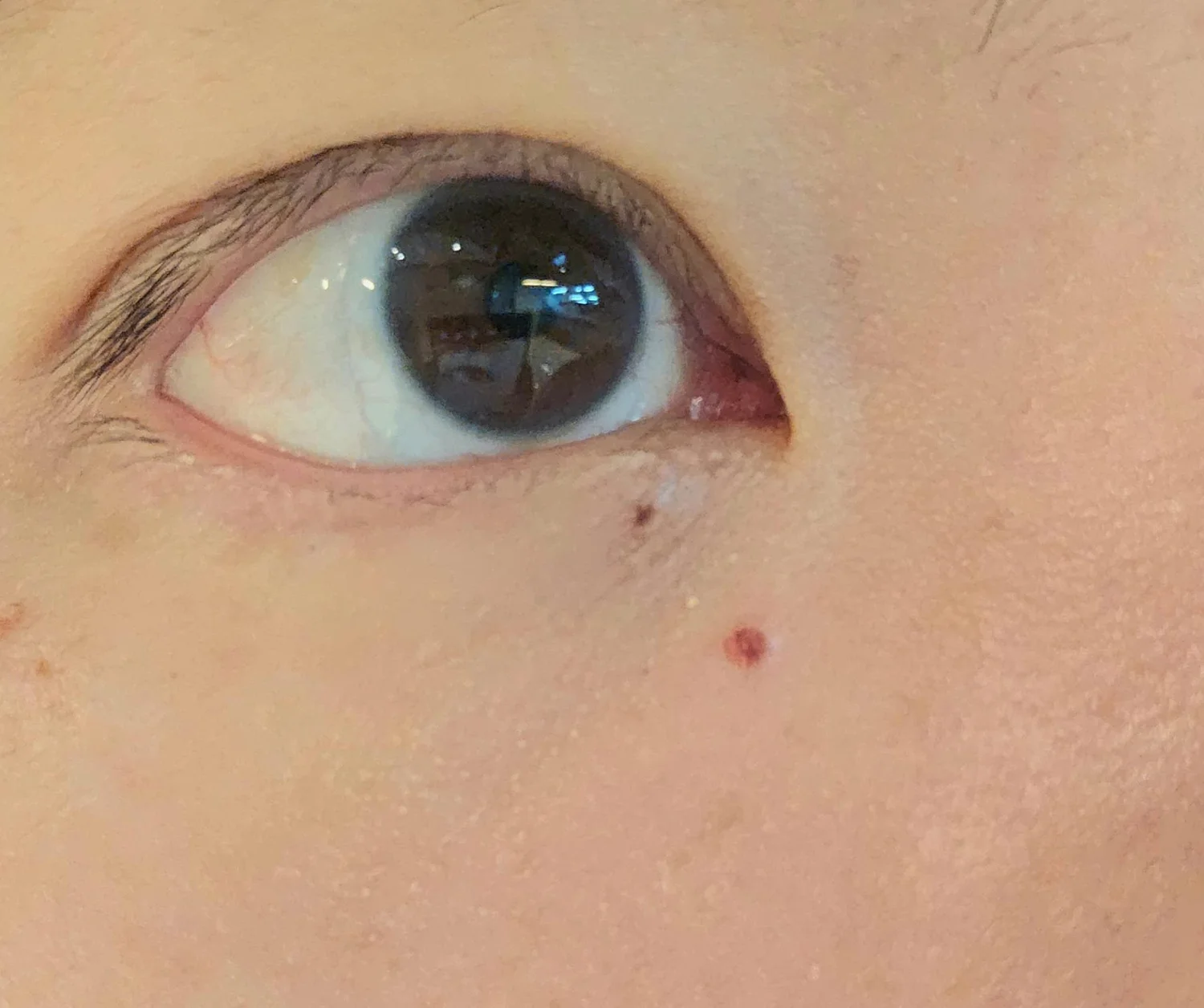 Milia Seed Removal | Skin Tag and oil clog removal in Singapore ...