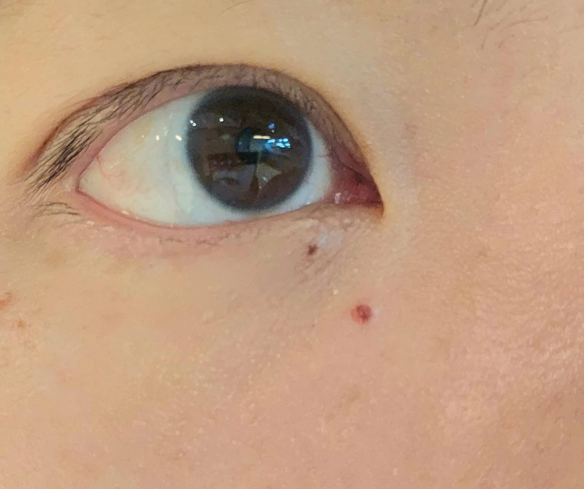 Milia Seed Removal | Skin Tag and oil clog removal in Singapore ...