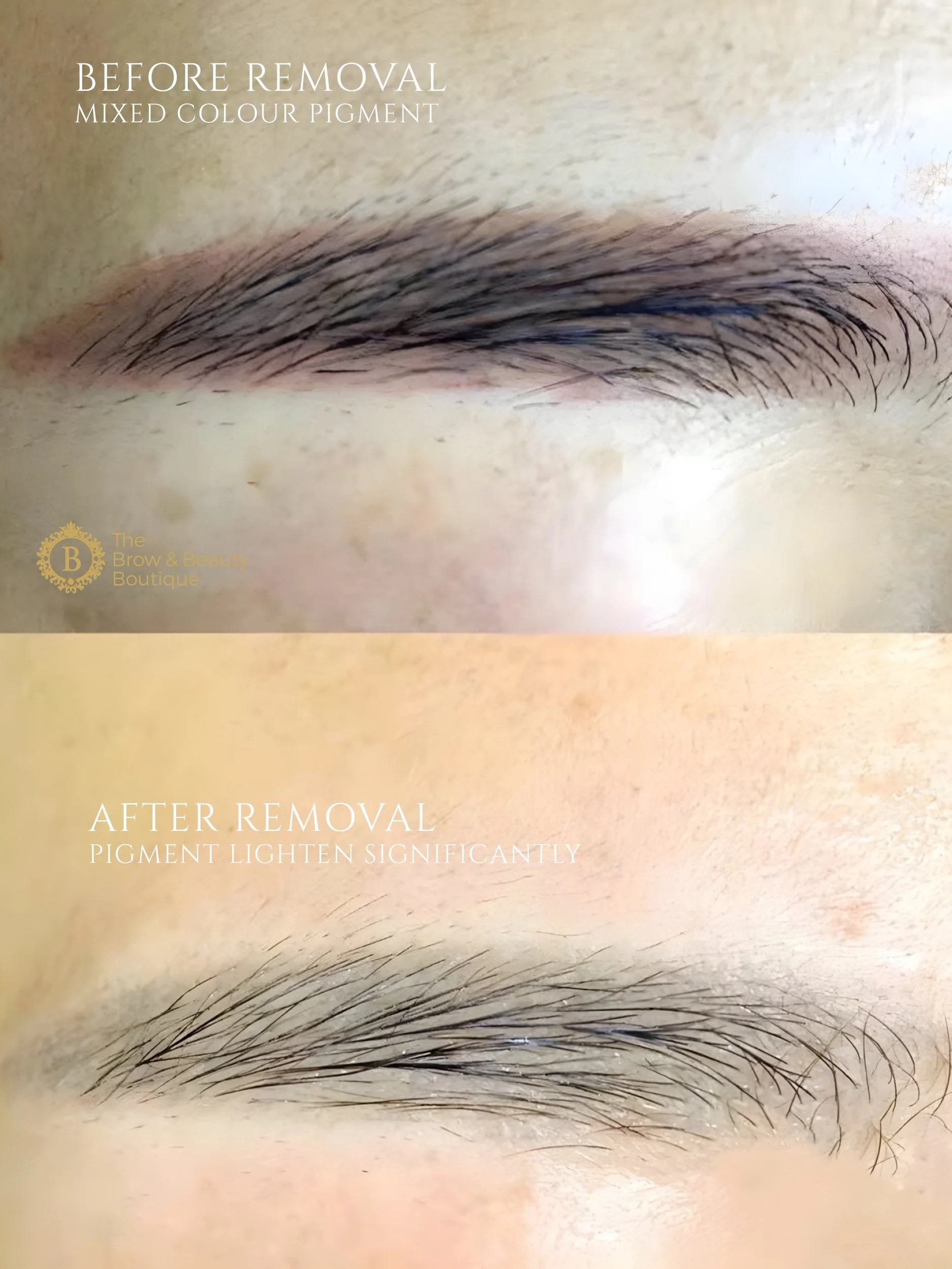 Eyebrow Removal (RF +Phiremoval) in Singapore- The Brow Beauty Boutique ...