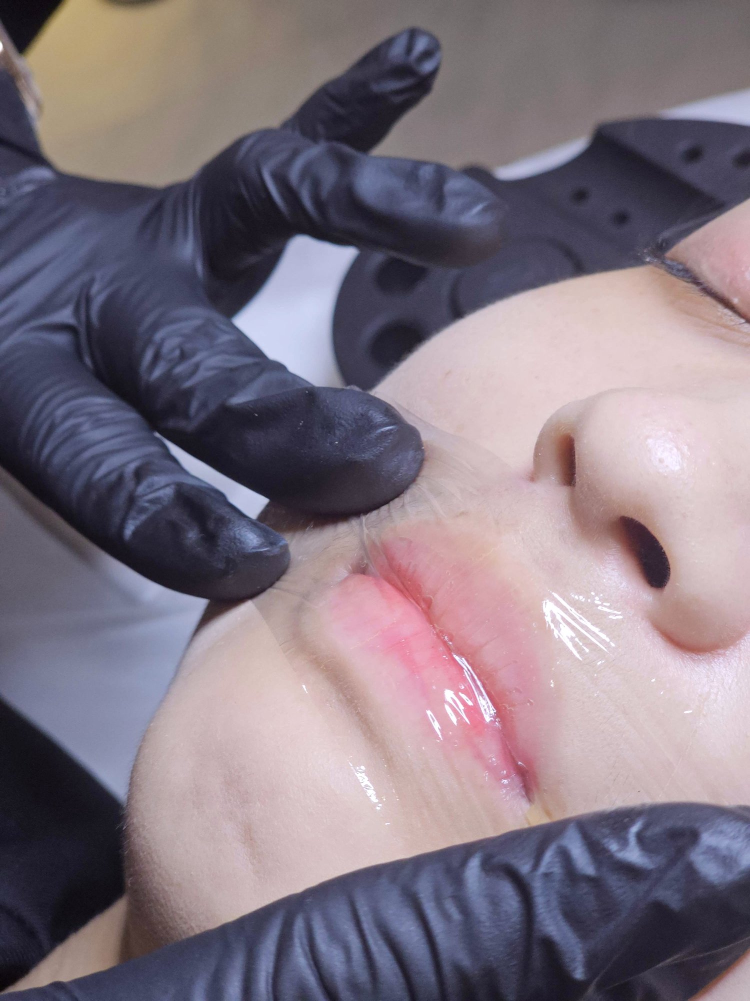 Lip Colour Removal in Singapore – Safe, Non-Invasive Treatment to ...