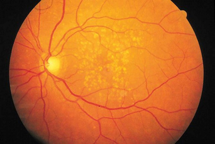 Glaucoma vs Macular Degeneration — Macular Degeneration New Zealand