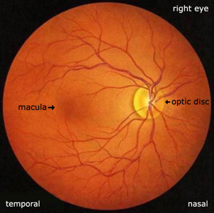 Glaucoma vs Macular Degeneration — Macular Degeneration New Zealand