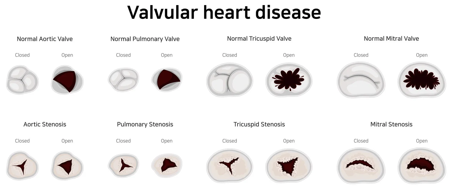 Structural Heart Disease — Hurstville Private Heart Centre · Cardiology ...