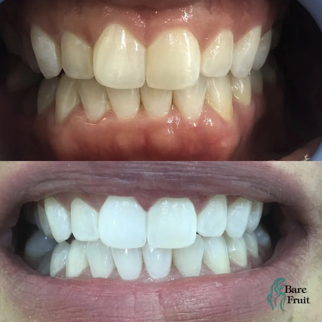 TEETH WHITENING — Bare Fruit Sugaring & Brow Studio by Shari Saint