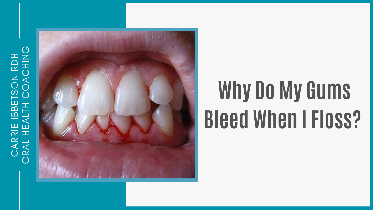 Bleeding Gums When Flossing: Here’s the Insight You Need — Carrie ...