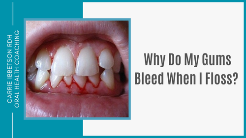 Bleeding Gums When Flossing: Here’s the Insight You Need — Carrie ...