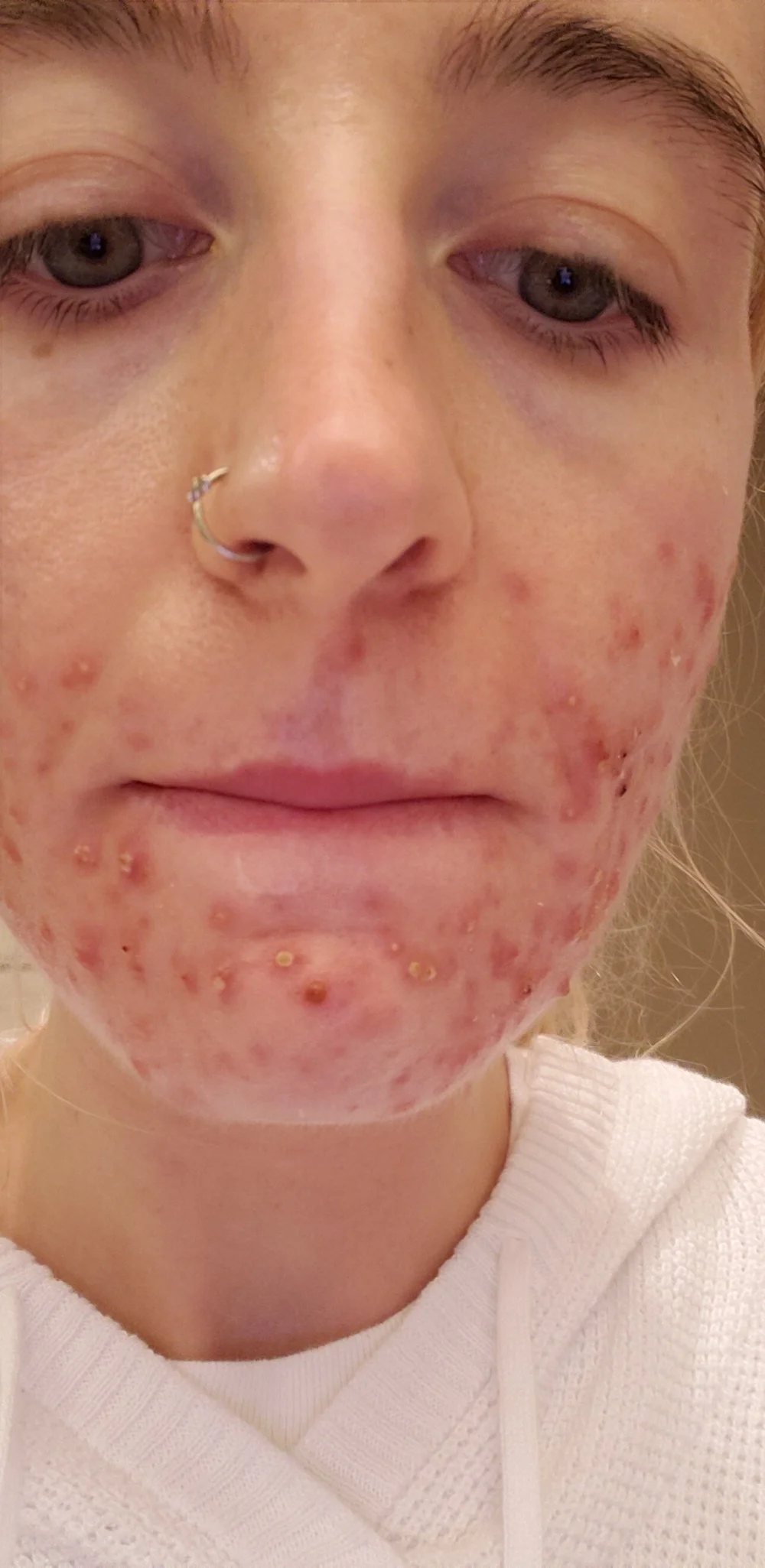 Accutane Before During And After