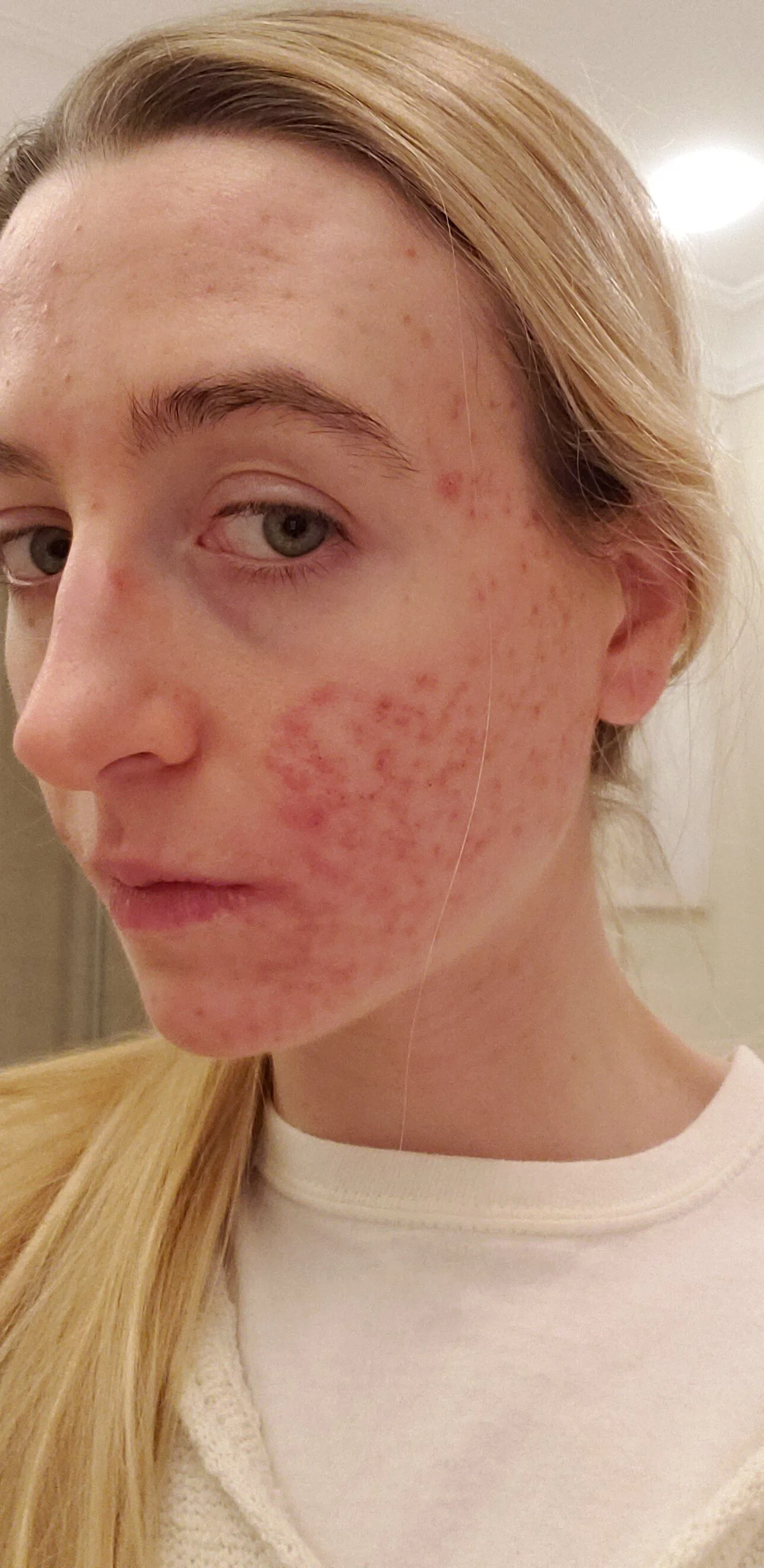 Accutane Results