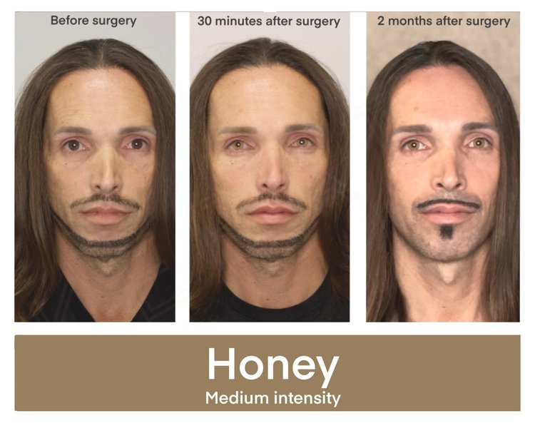 Results and Examples — Eye Color Change — KERATO