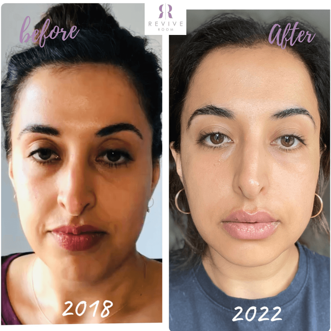 Before And After Face Yoga